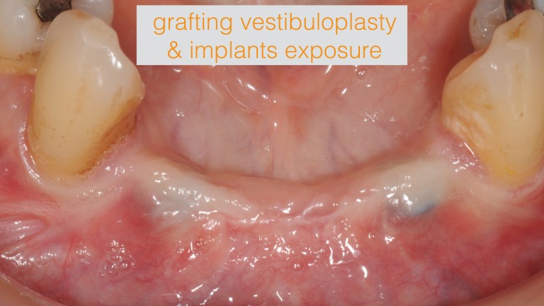 Online Course: Vestibuloplasty: Indications and Techniques for ...