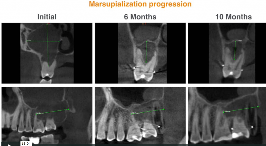 decompression___marsupialization_technique_for_management_of_maxillary ...