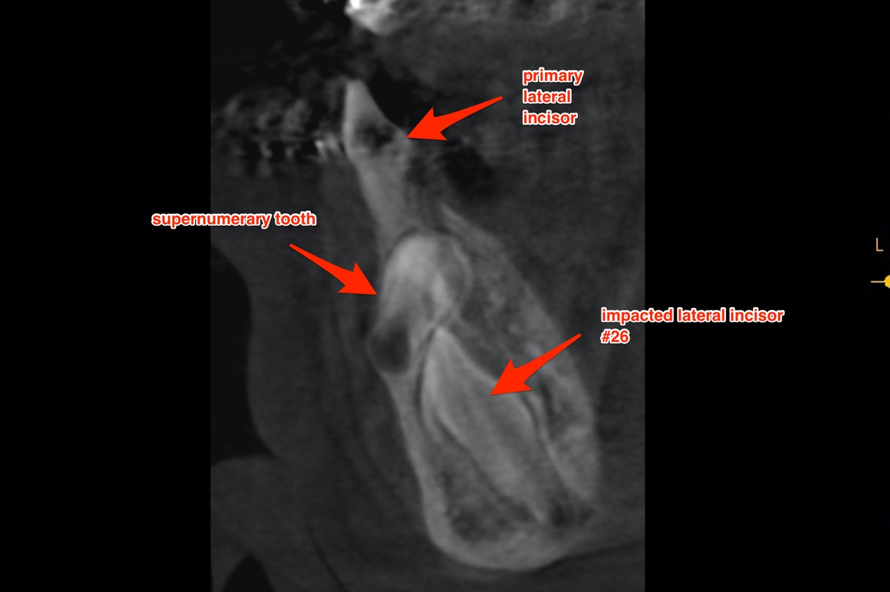 Extraction of Supernumerary Tooth and Exposure of Impacted Lower ...