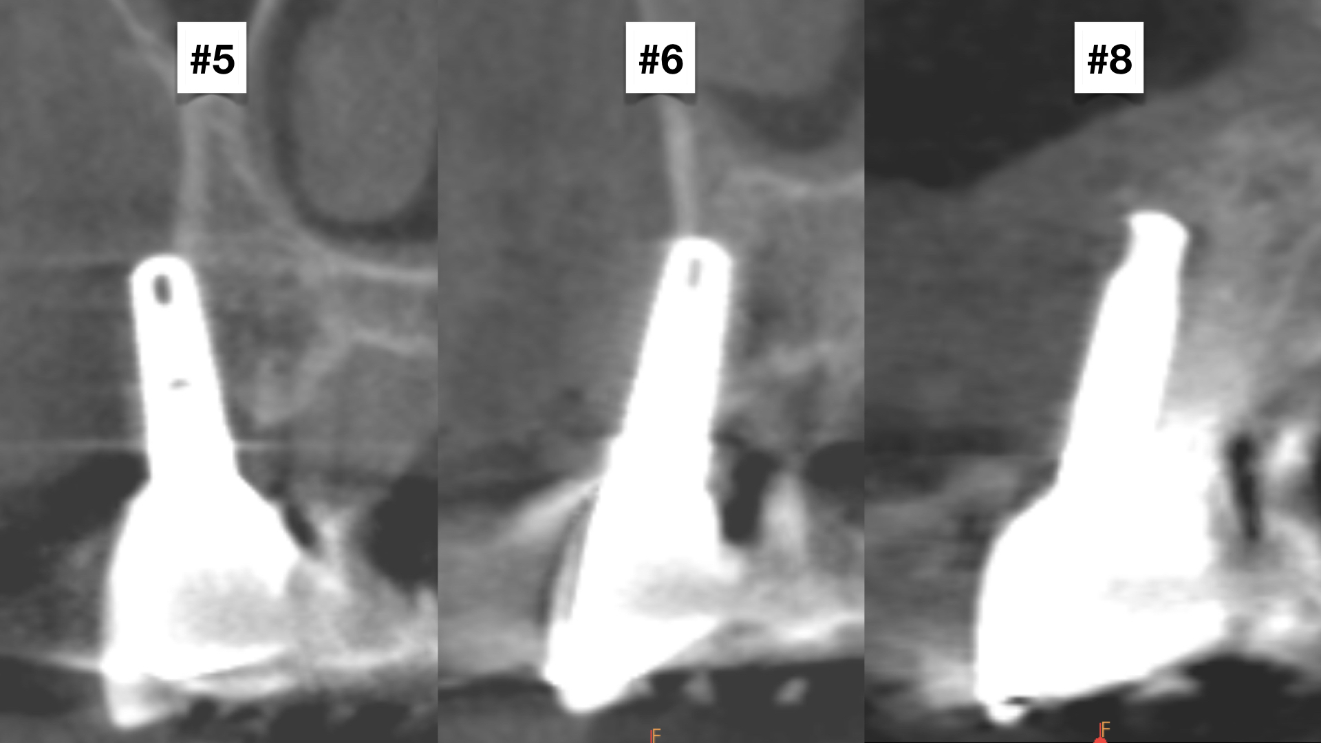 Benefits of CBCT in Diagnosis of Bony Defects Involving Teeth or Dental ...