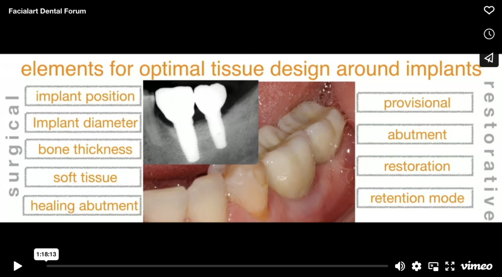 Online Course: How to Create Natural Gingival Form, Achieve Better ...