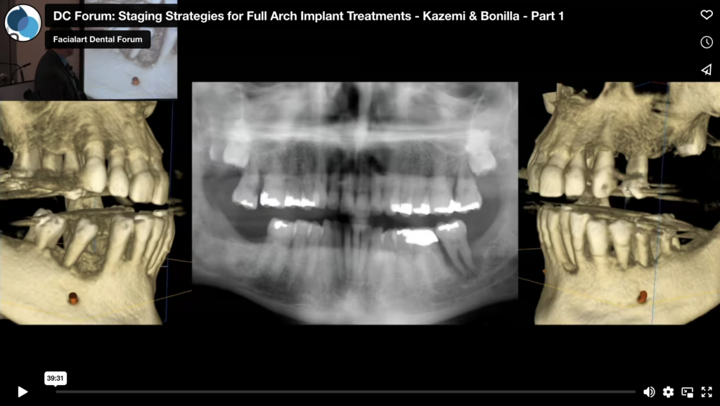 Online Course- Staging Strategies For Full-Arch Implant Supported Crown ...