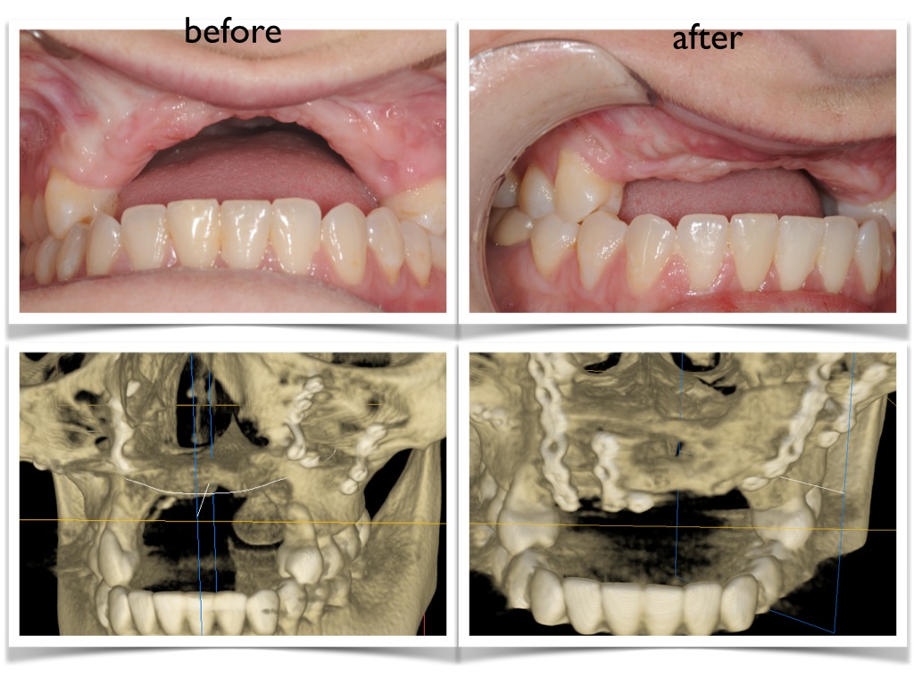 Maxillary Bone Augmentation for Dental Implants | Maxillary Bone ...